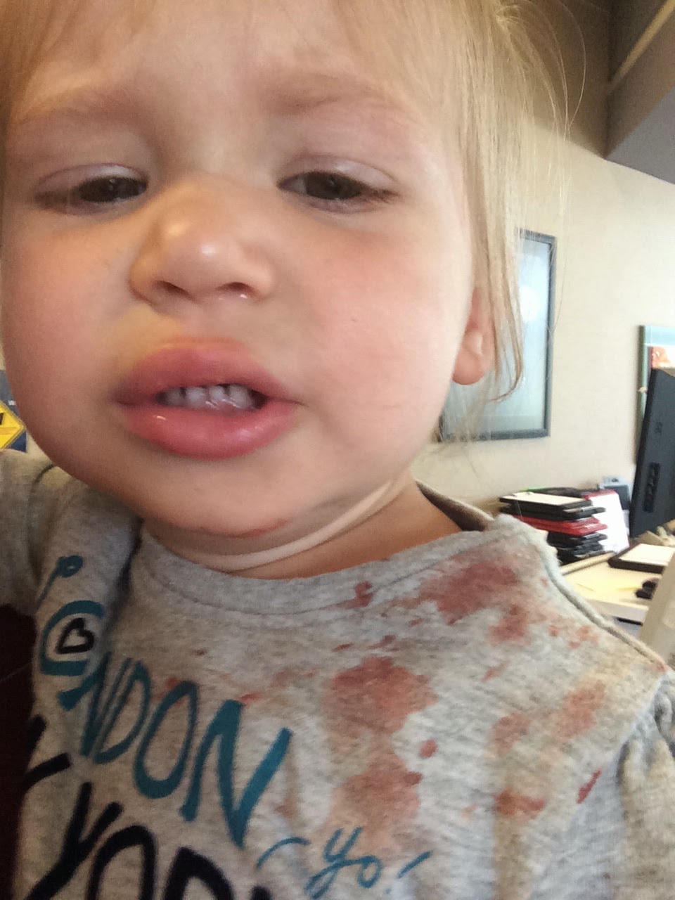 Daily Ava: Today Ava Busted Open Her Chin